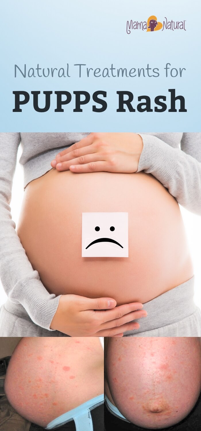 Treatment Of Skin Rash During Pregnancy at Lanny Rivera blog